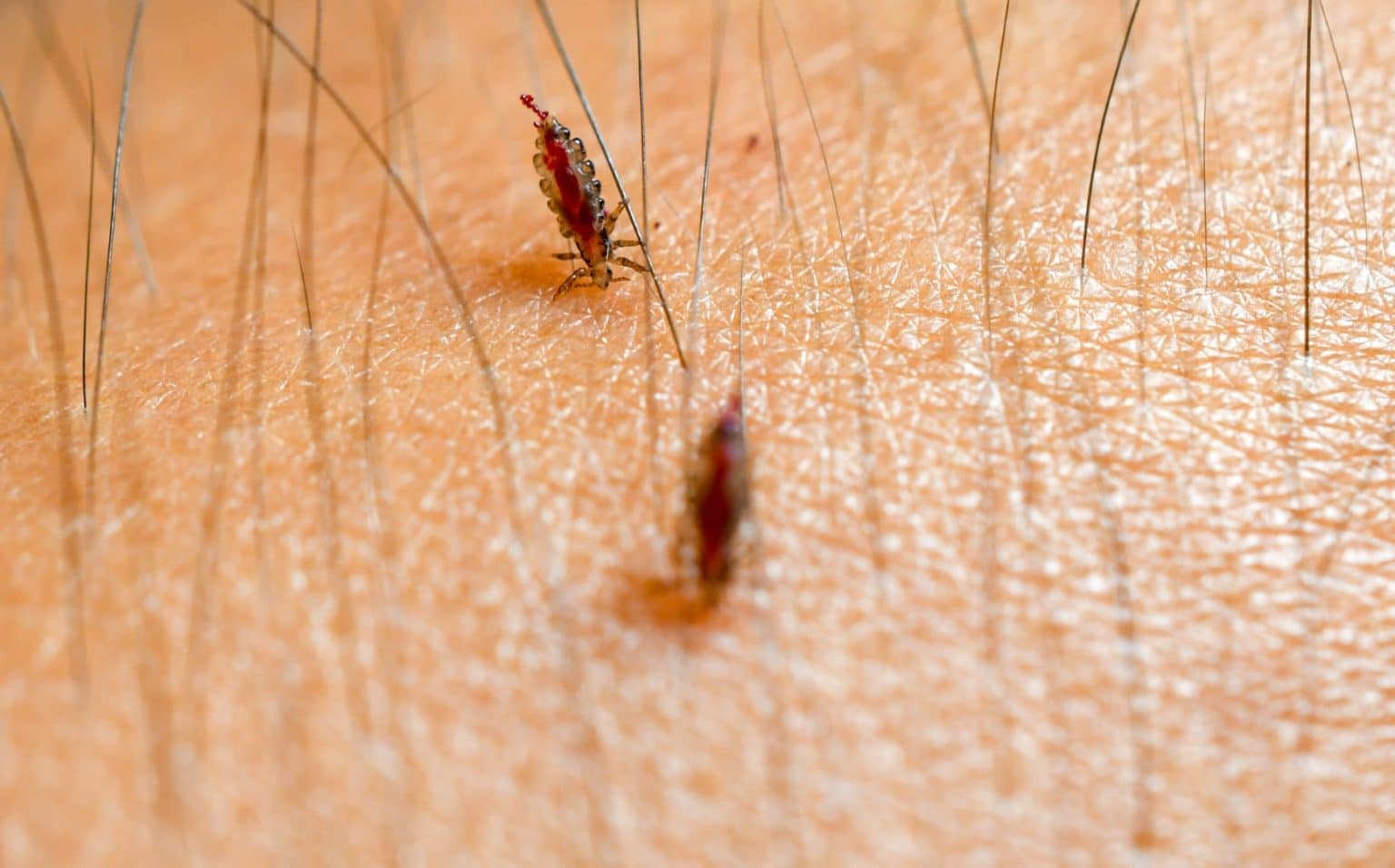 What Lice Bites Look Like | Identify And Treat Austin