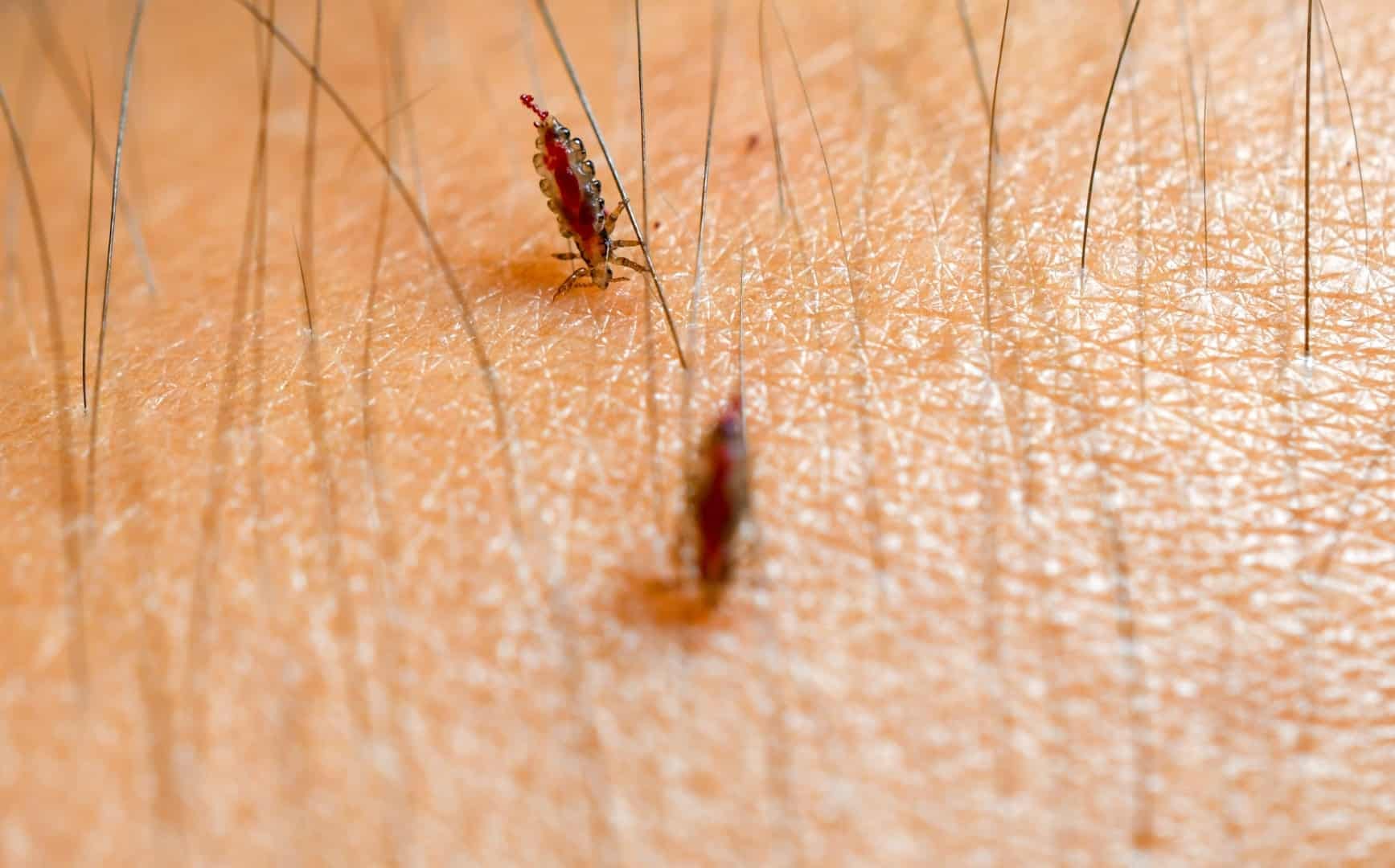 What Lice Bites Look Like | Identify And Treat Austin